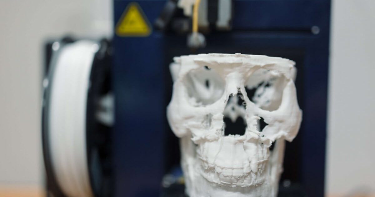 Can a 3D print of an MRI scan help one man get his face back? - FabCafe ...